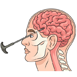 Instant Lobotomy(respawn) - Minecraft Mods - CurseForge